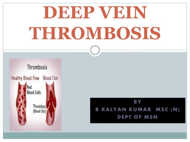 DVT (Deep vein thrombosis) | PDF