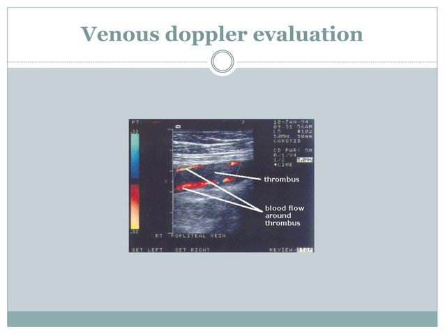 DVT (Deep vein thrombosis) | PDF