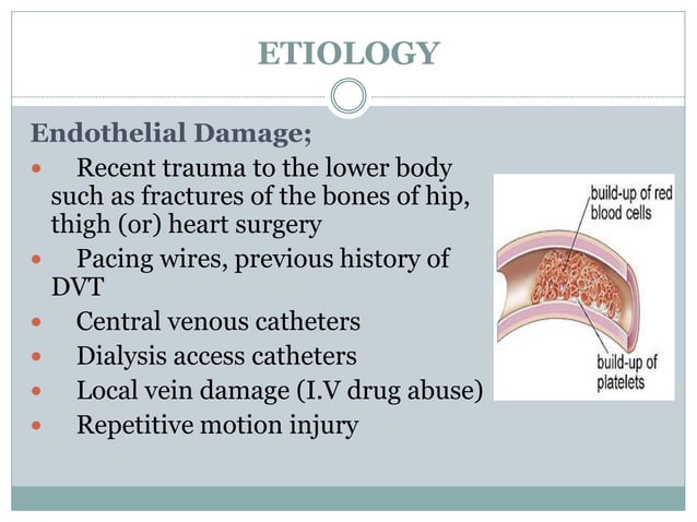 DVT (Deep vein thrombosis) | PDF