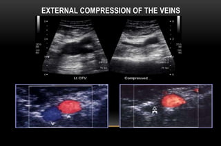 Deep vein thrombosis Ultrasound | PPTX