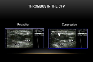 Deep vein thrombosis Ultrasound | PPTX