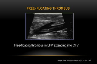 Deep vein thrombosis Ultrasound | PPTX