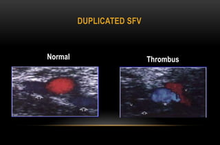 Deep vein thrombosis Ultrasound | PPTX
