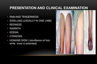 Deep vein thrombosis Ultrasound | PPTX