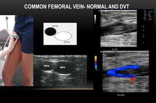 Deep vein thrombosis Ultrasound | PPTX
