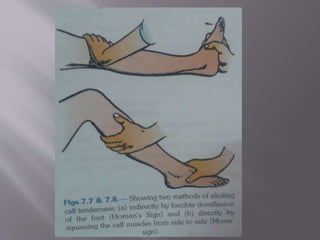 Deep vein thrombosis agp | PPT