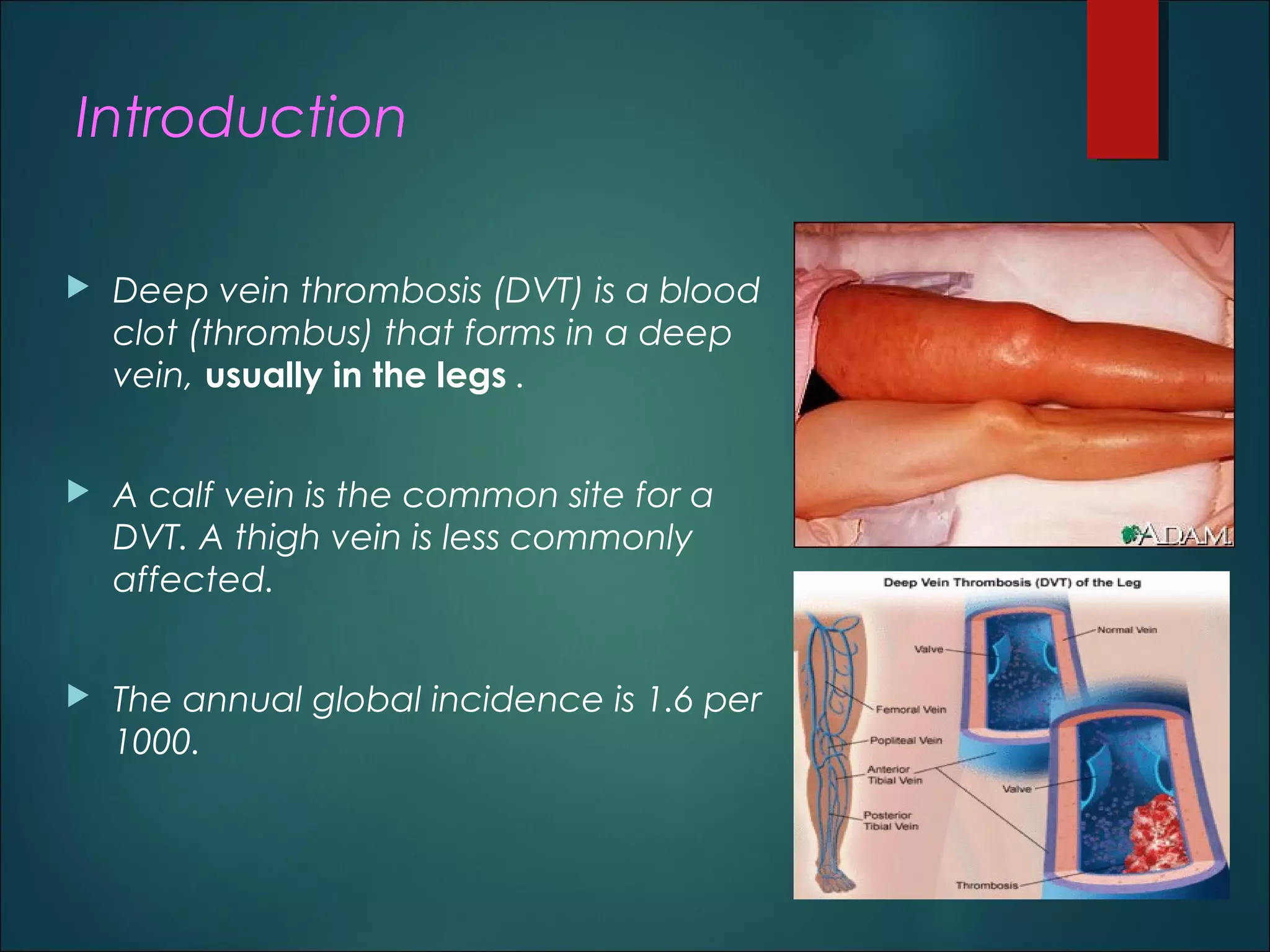 Deep vein thrombosis | PPT