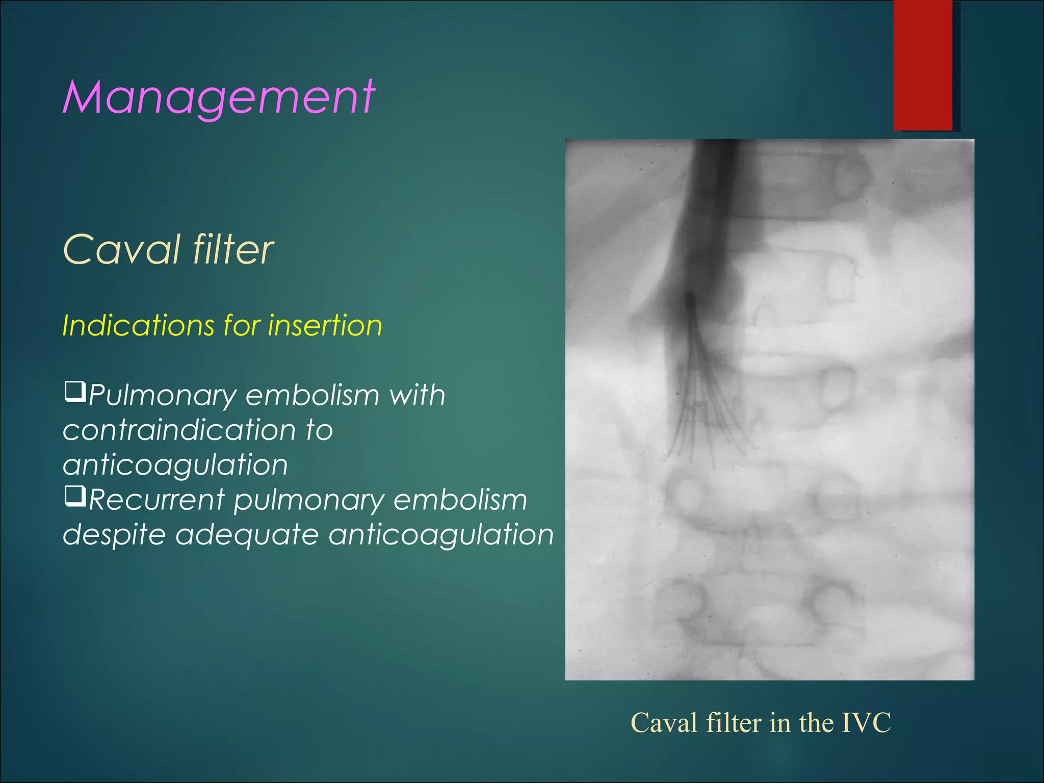 Deep vein thrombosis | PPT