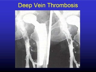 Deep vein thrombosis (dvt) | PPT
