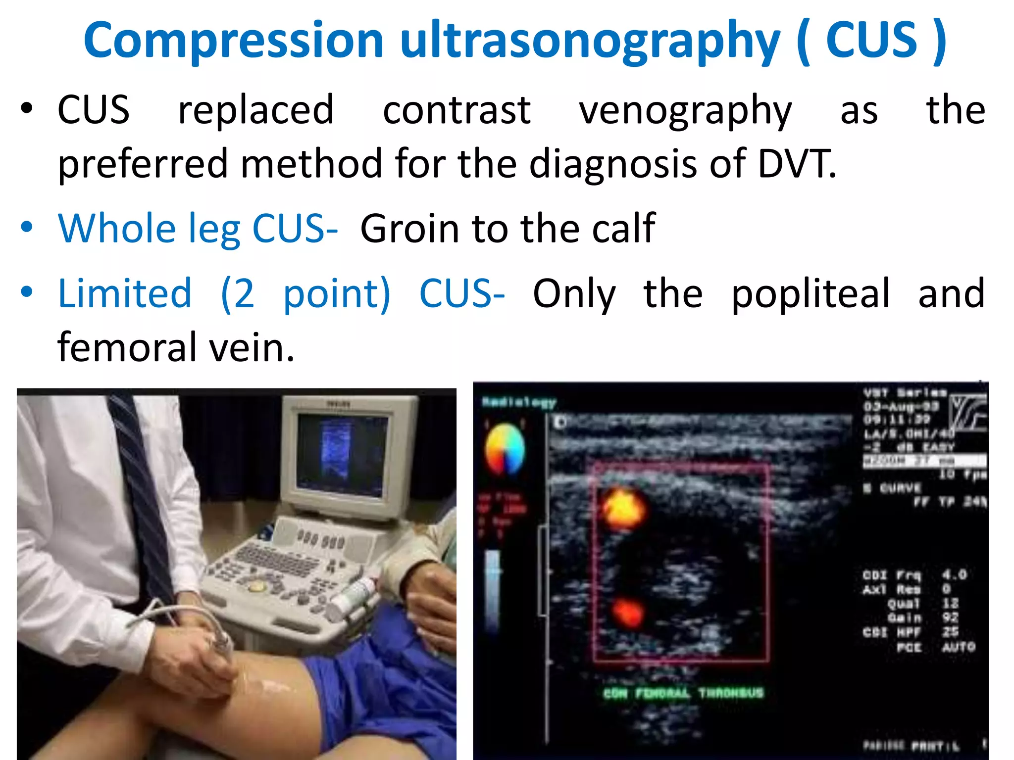 Deep vein thrombosis (DVT) and Pulmonary embolism (PE) | PPTX