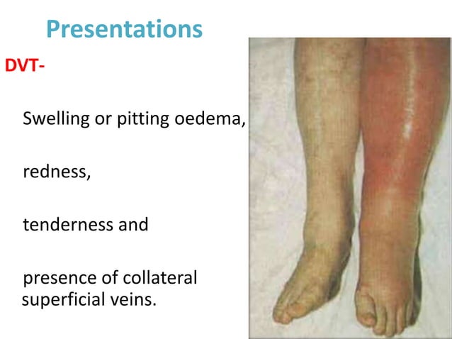 Deep vein thrombosis (DVT) and Pulmonary embolism (PE) | PPTX | Blood ...