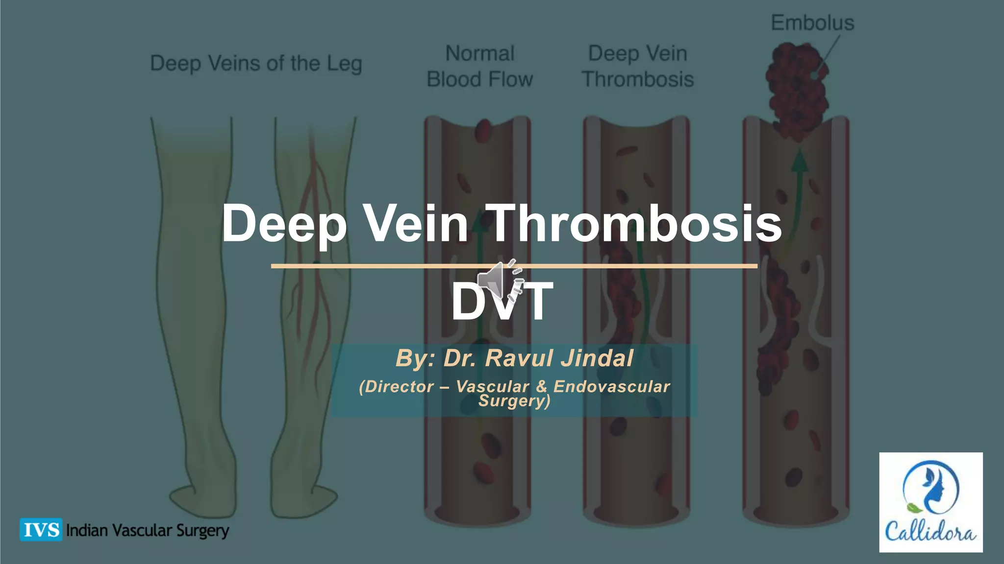 Deep Vein Thrombosis General Awareness | PPT