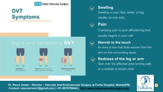 Deep Vein Thrombosis General Awareness | PPT