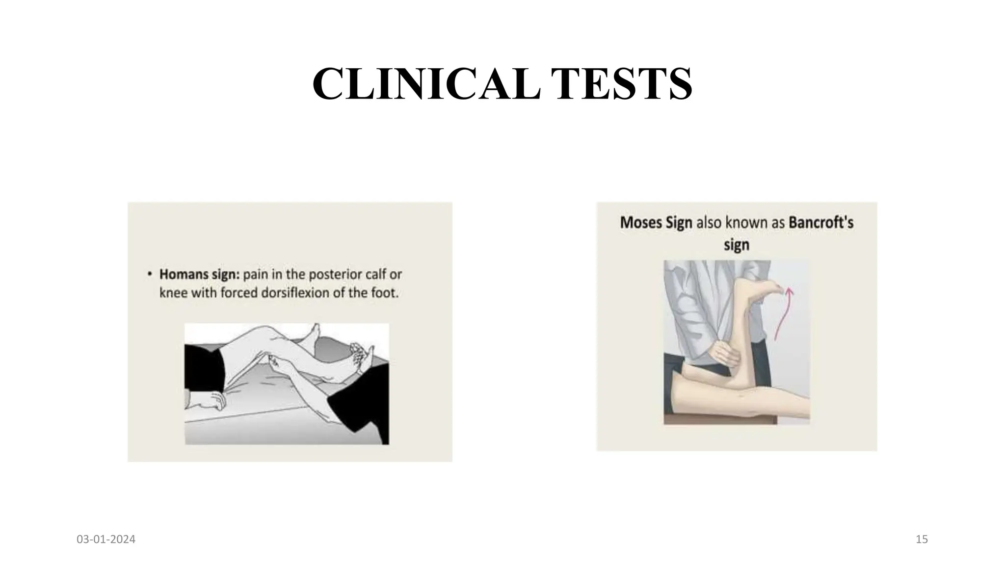 Deep Vein Thrombosis physiotherapy. pptx | PPTX