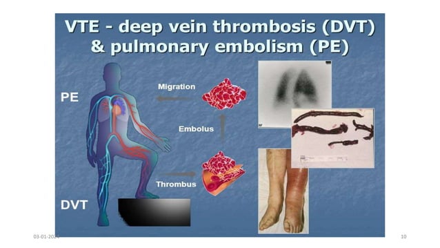 Deep Vein Thrombosis physiotherapy. pptx | PPTX