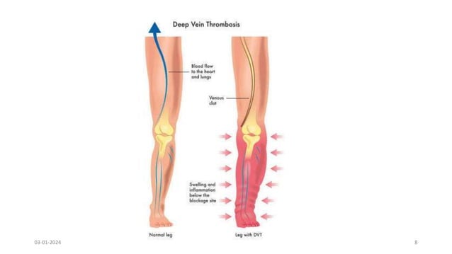 Deep Vein Thrombosis physiotherapy. pptx | PPTX
