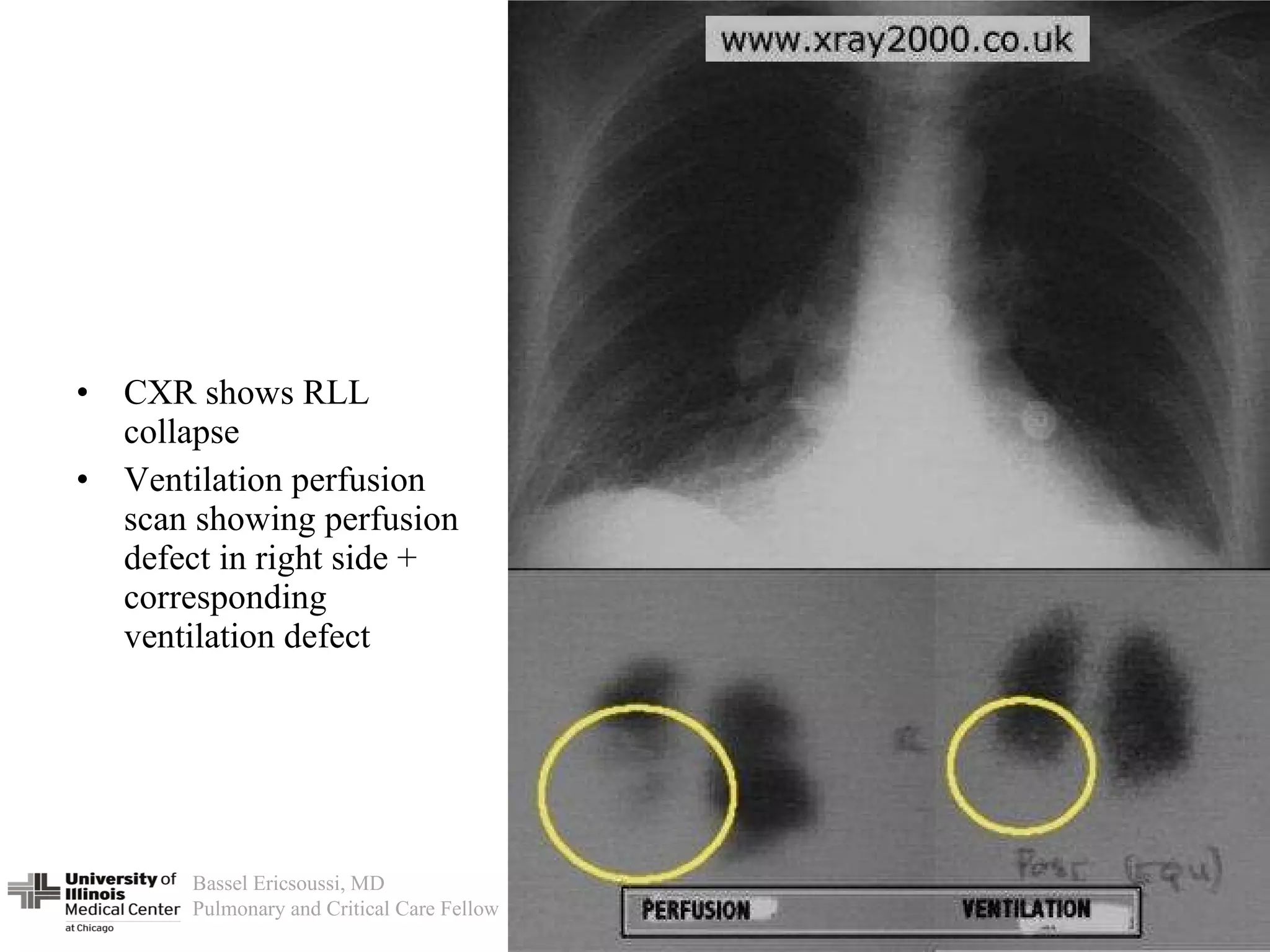 Deep Venous Thrombosis and Pulmonary Embolism : Diagnostic Approach and ...