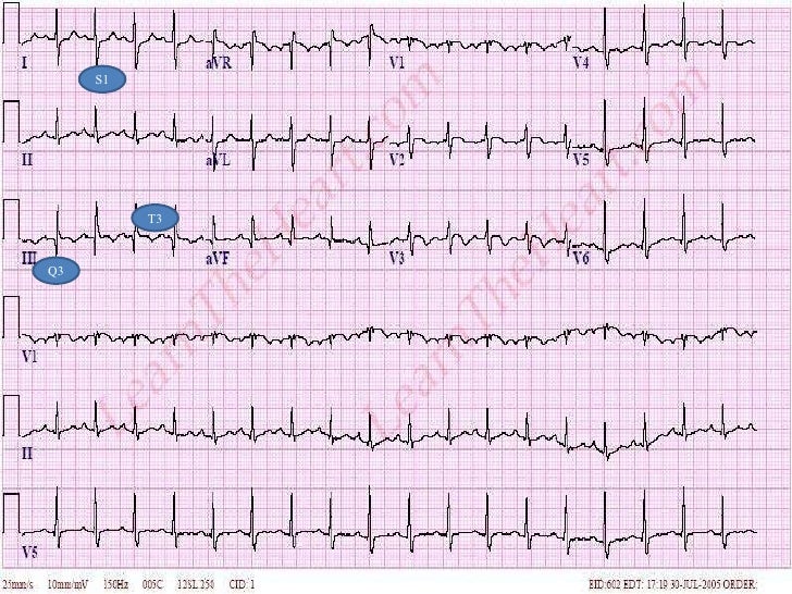Deep Venous Thrombosis and Pulmonary Embolism : Diagnostic Approach a…