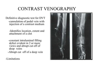 Deep venous thrombosis | PPT