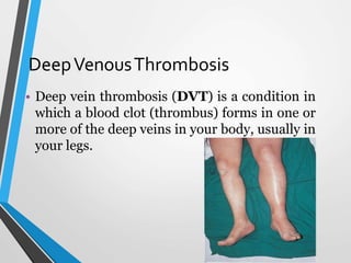Deep venous thrombosis dvt | PPTX