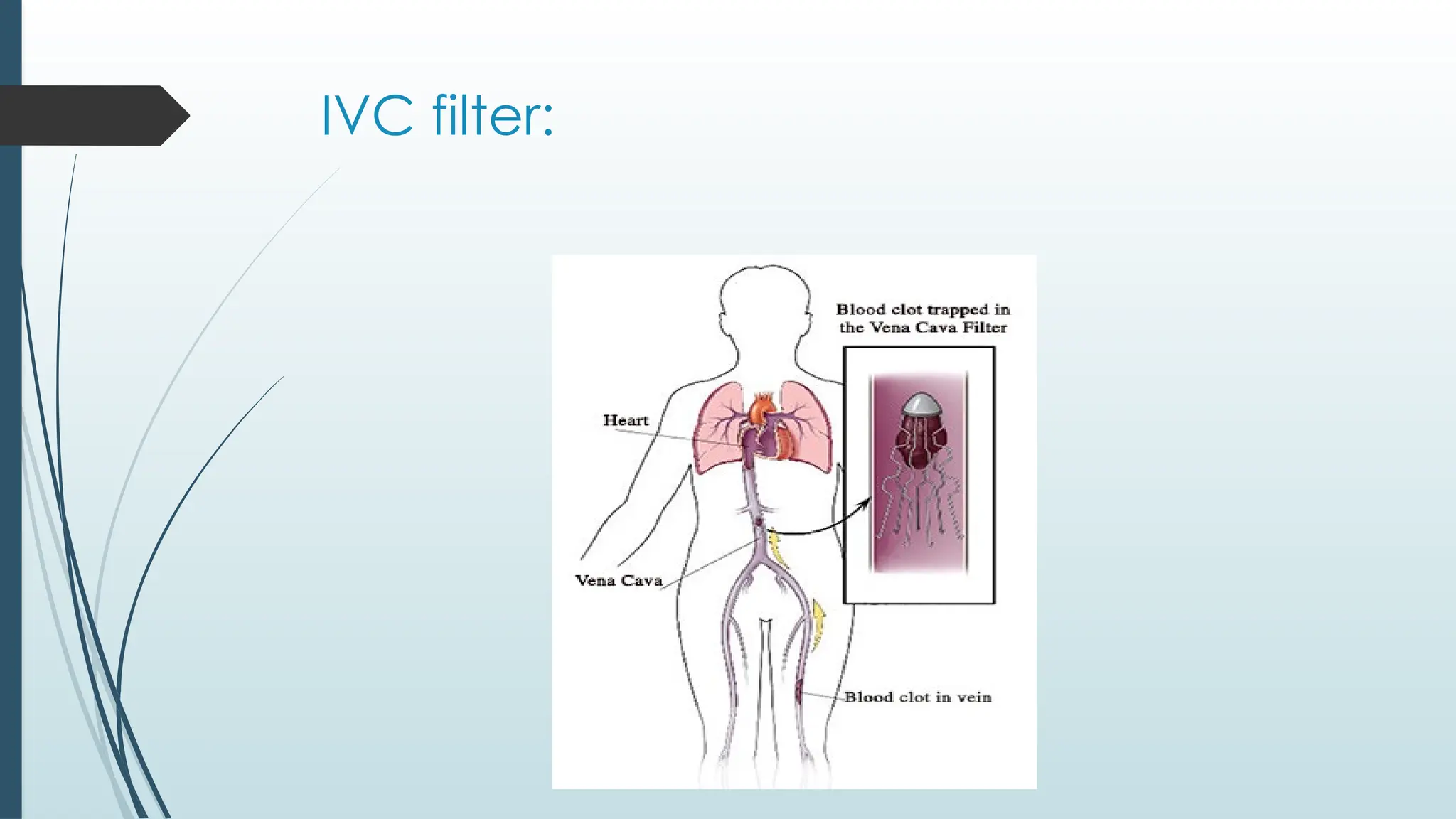 DEEP VENOUS THROMBOSIS(DVT)- A Presentation.pptx