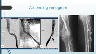 DEEP VENOUS THROMBOSIS(DVT)- A Presentation.pptx