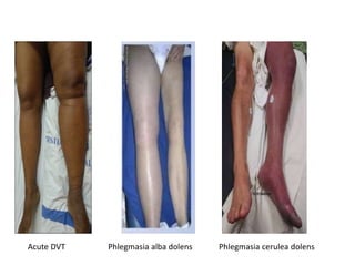 Deep venous thrombosis ppt | PPTX