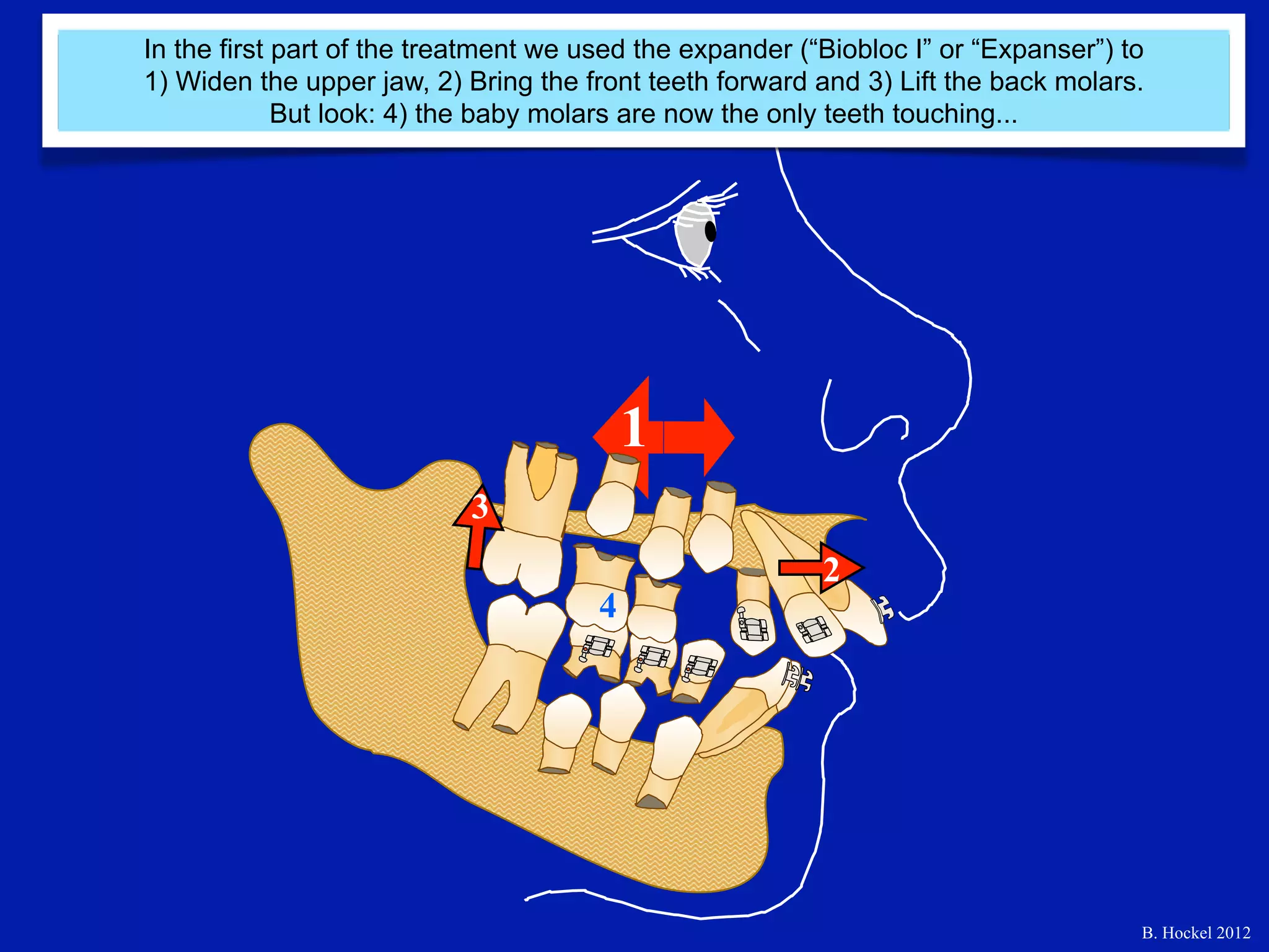 De extraction explanation | PDF