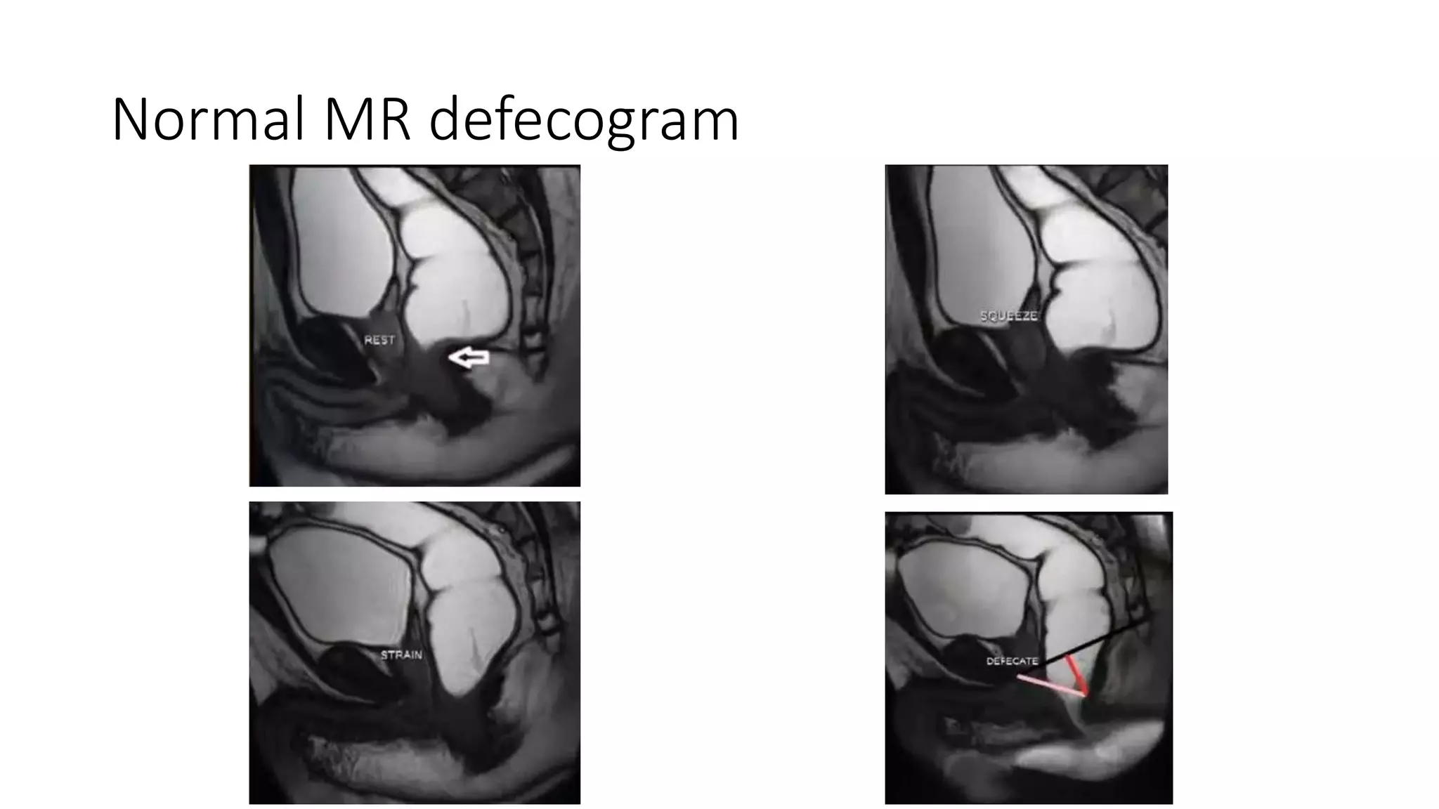 Defecography 1 Pptx