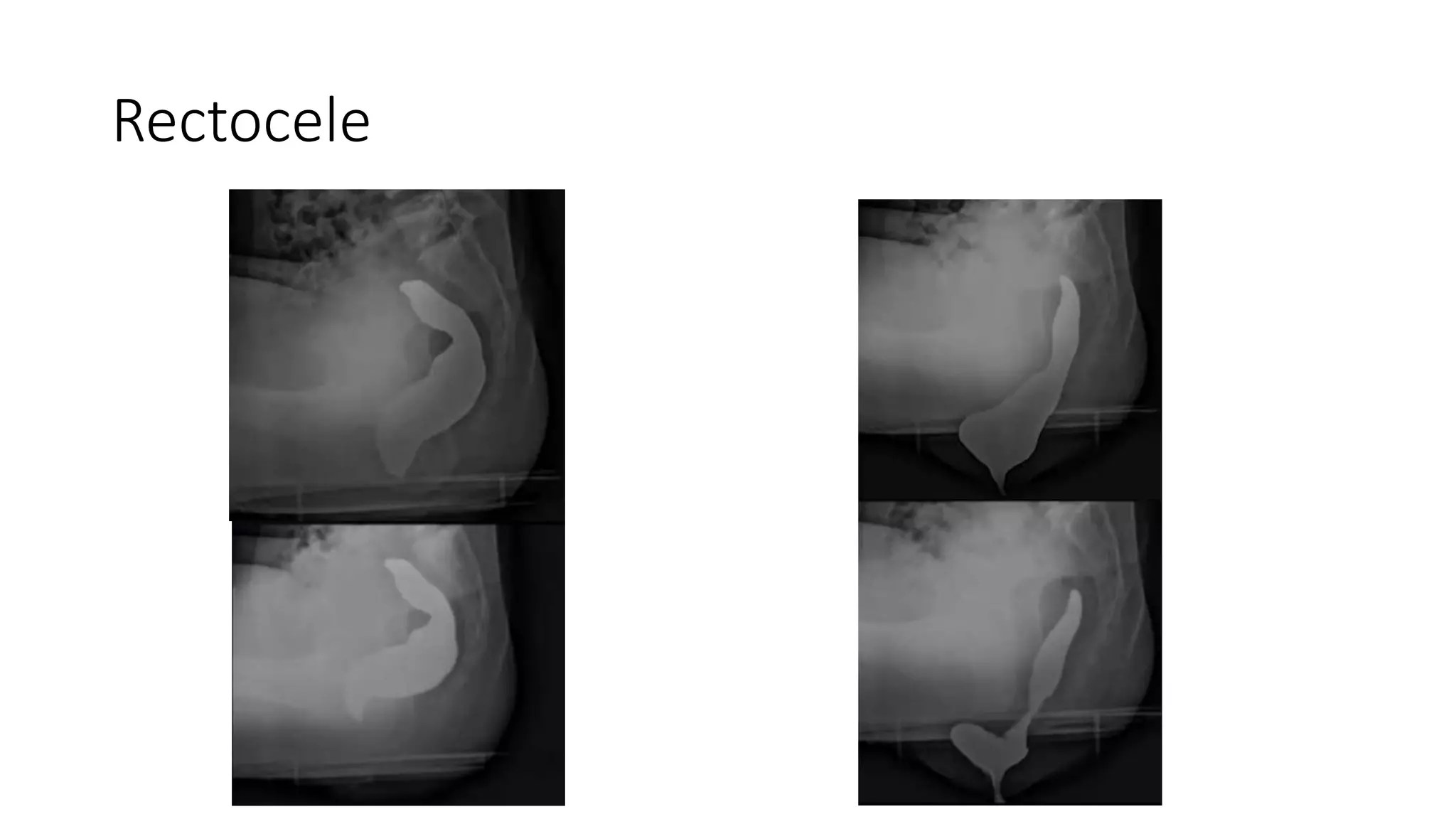 Defecography (1).pptx
