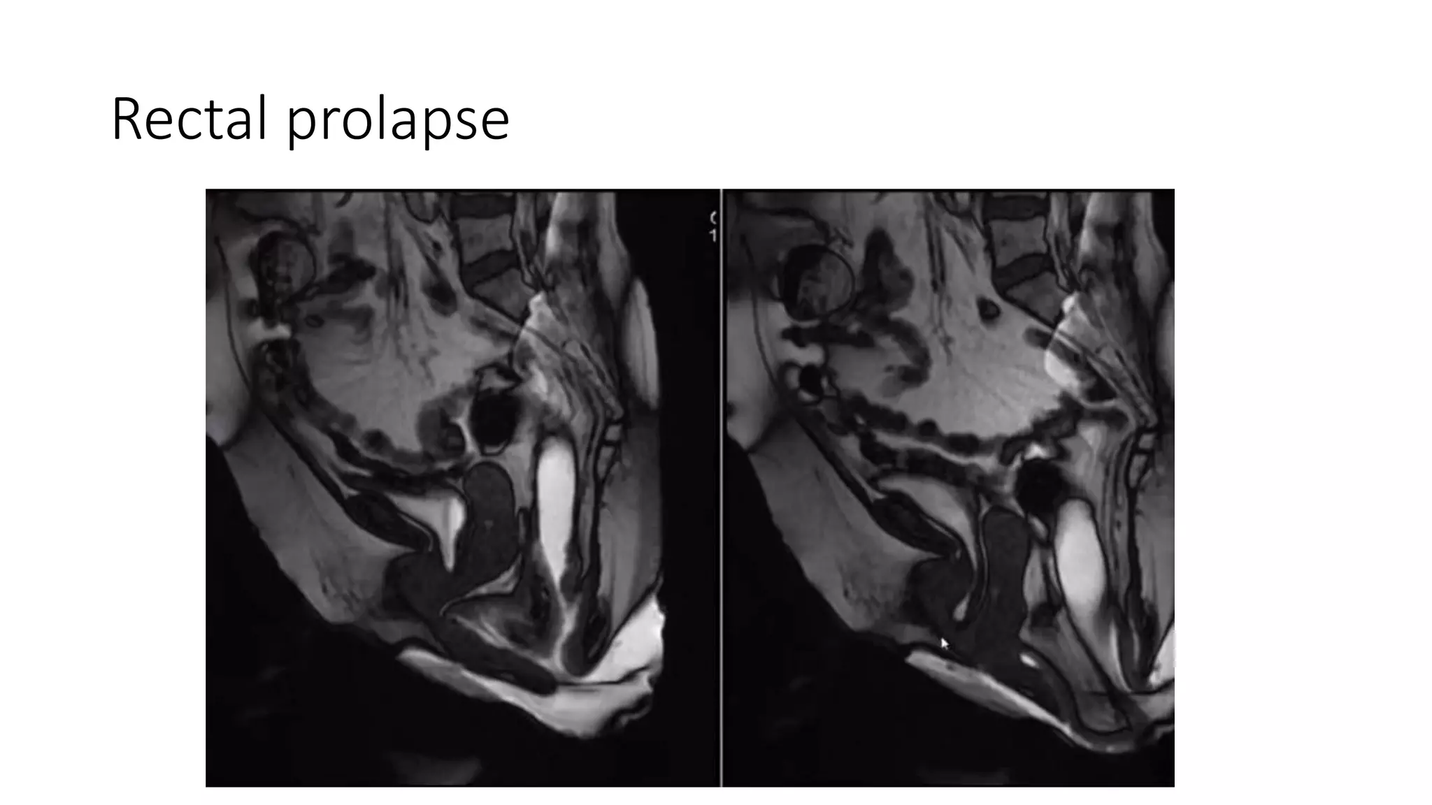 Defecography (1).pptx