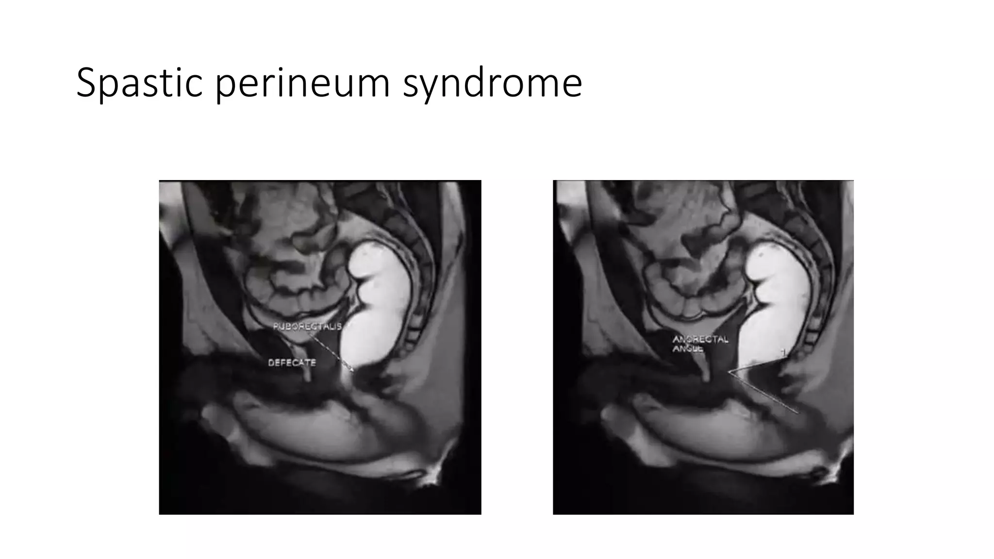 Defecography (1).pptx