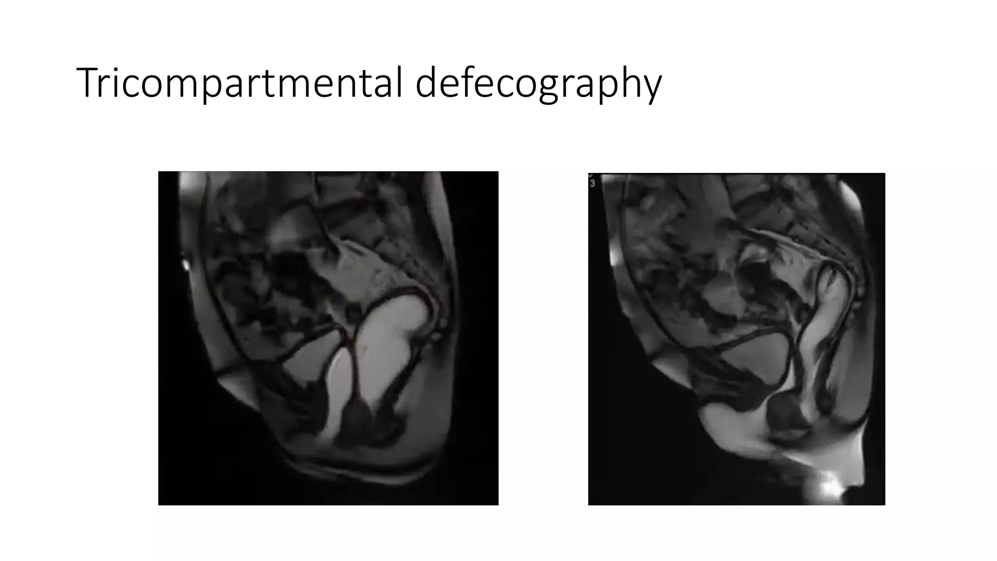 Defecography (1).pptx
