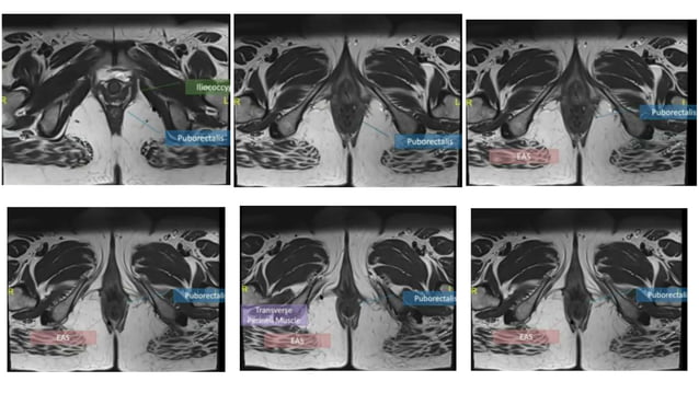 Defecography (1).pptx | Digestive Disorders | Diseases and Conditions