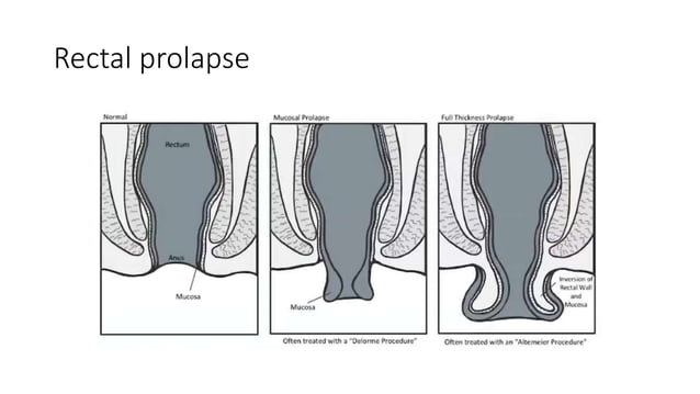 Defecography (1).pptx | Digestive Disorders | Diseases and Conditions