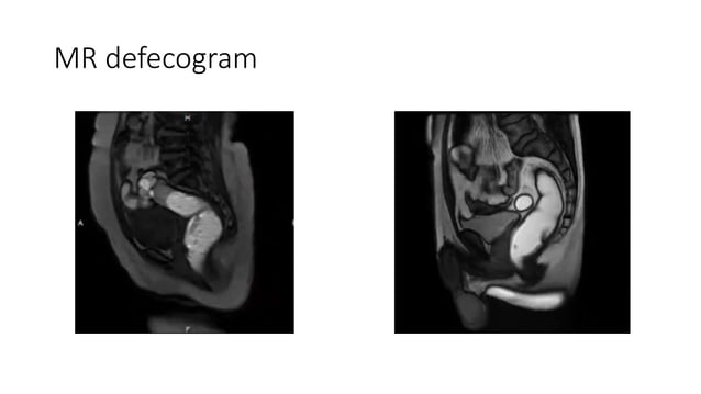 Defecography (1).pptx | Digestive Disorders | Diseases and Conditions