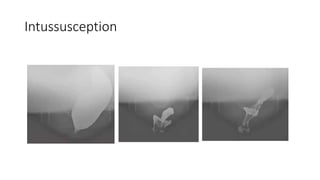 Defecography (1).pptx