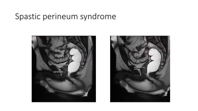 Defecography (1).pptx | Digestive Disorders | Diseases and Conditions