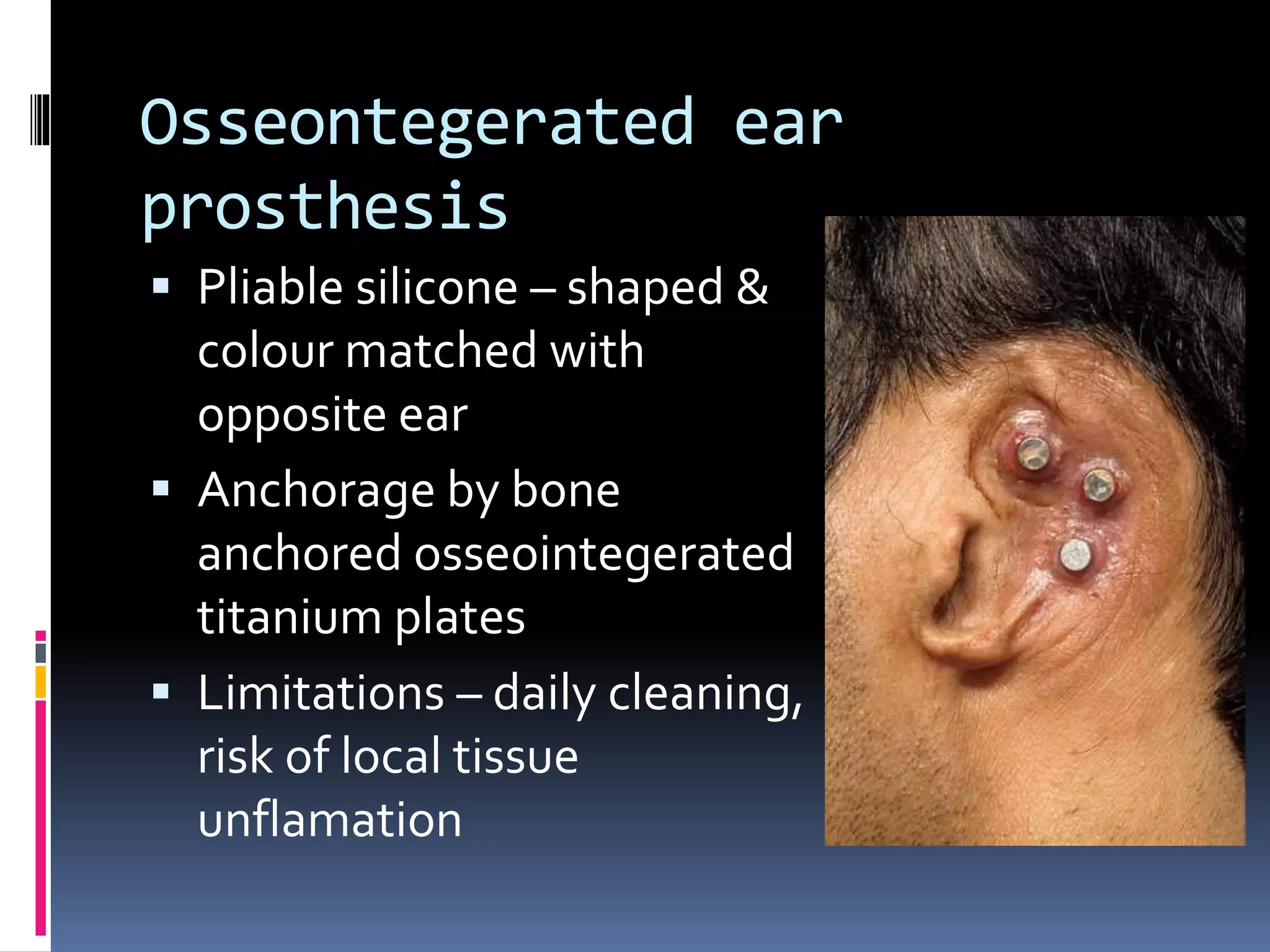 Defect based reconstruction of ear | PPTX