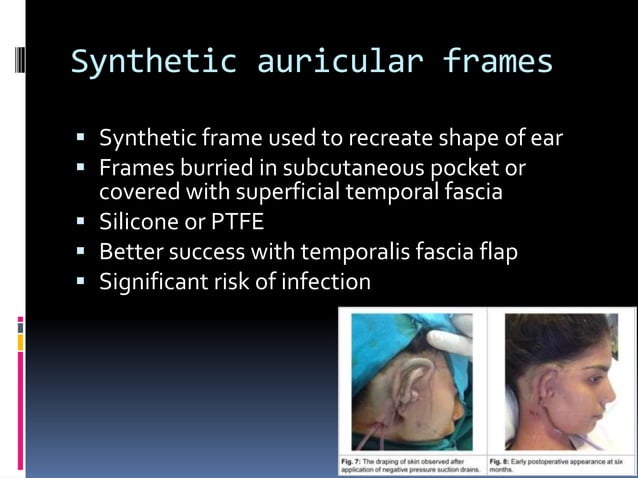 Defect based reconstruction of ear | PPT