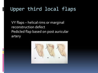 Defect based reconstruction of ear | PPTX