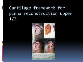 Defect based reconstruction of ear | PPTX