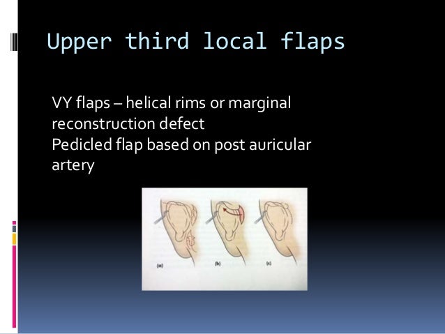 Defect based reconstruction of ear
