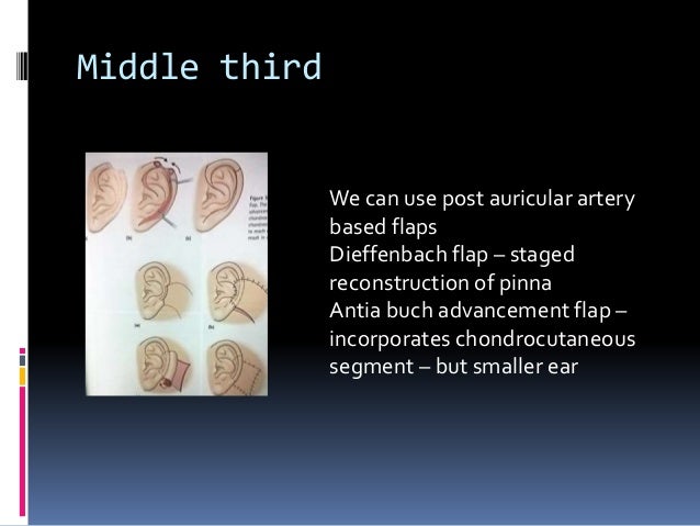 Defect based reconstruction of ear