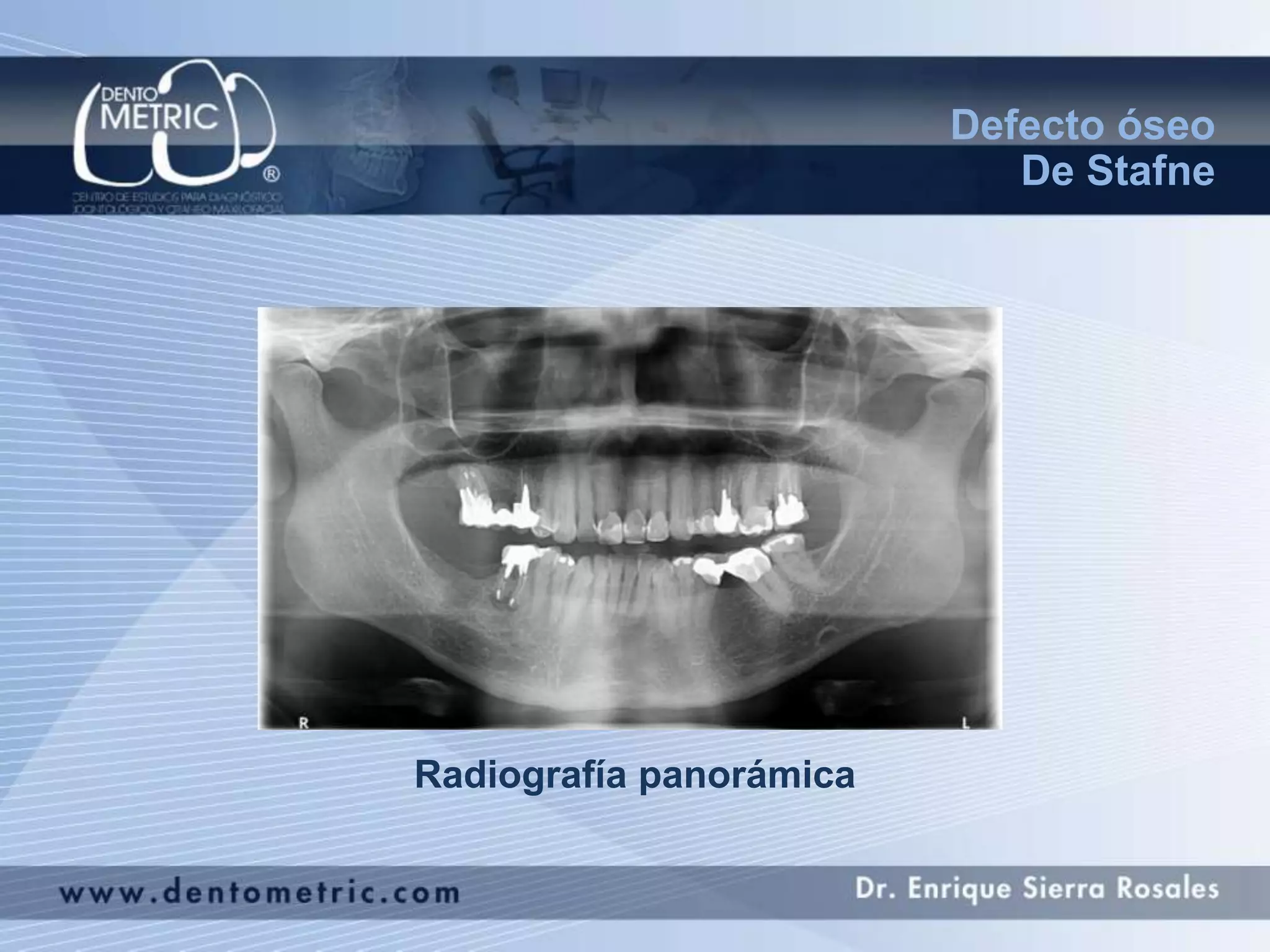 Defecto oseo de stafne | PPTX