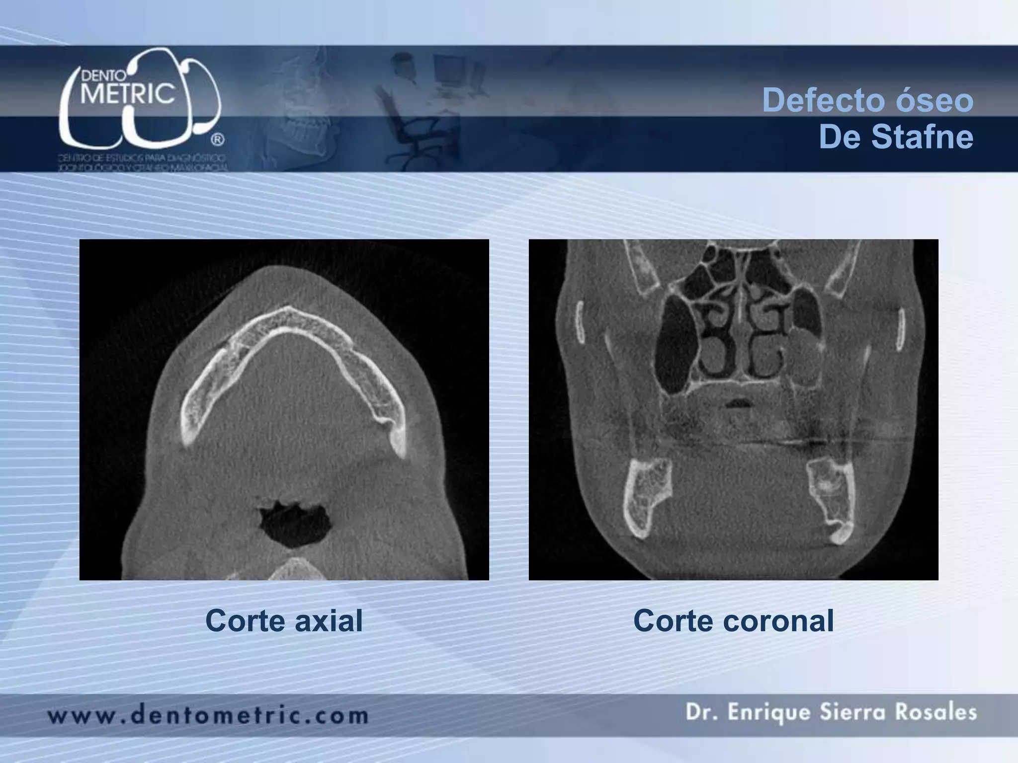 Defecto oseo de stafne | PPTX