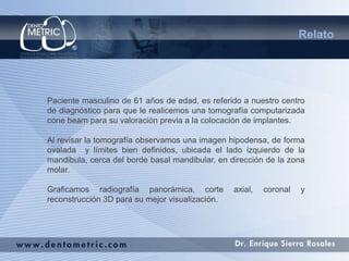 Defecto oseo de stafne | PPTX