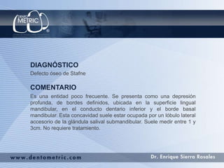 Defecto oseo de stafne | PPTX