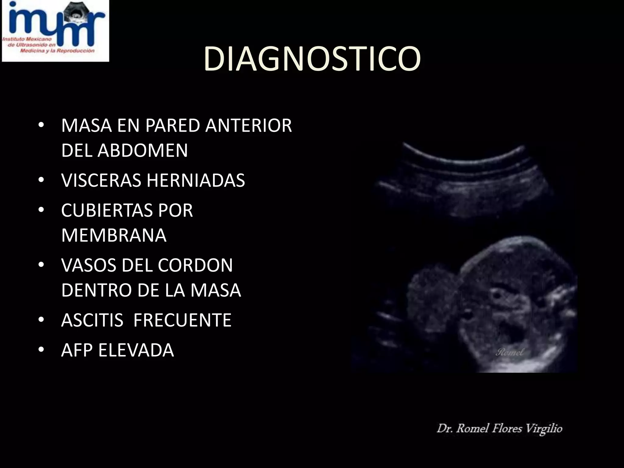 Defectos de la pared abdominal fetal.ppt para slsh | PPT