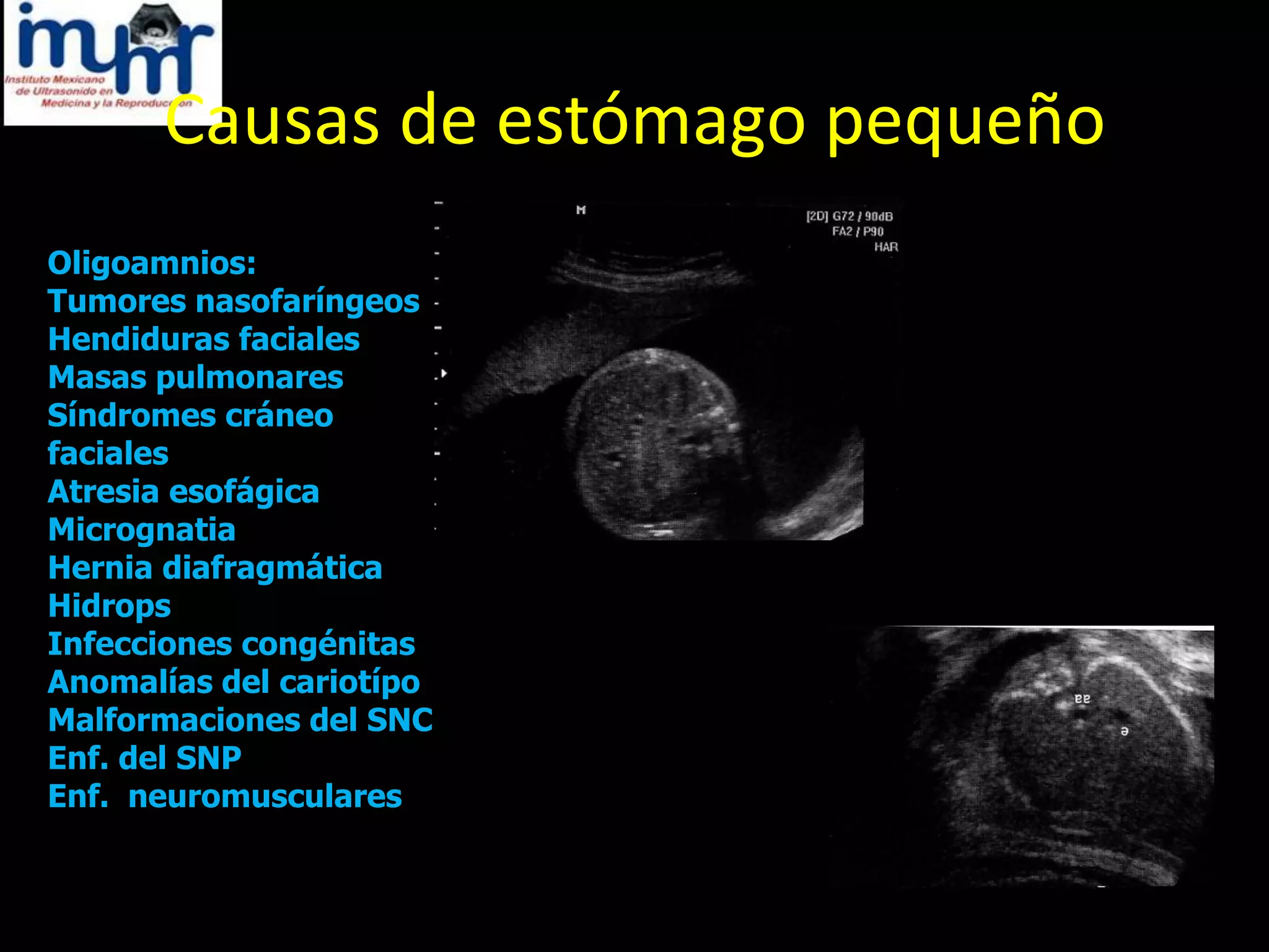 Defectos de la pared abdominal fetal.ppt para slsh | PPT